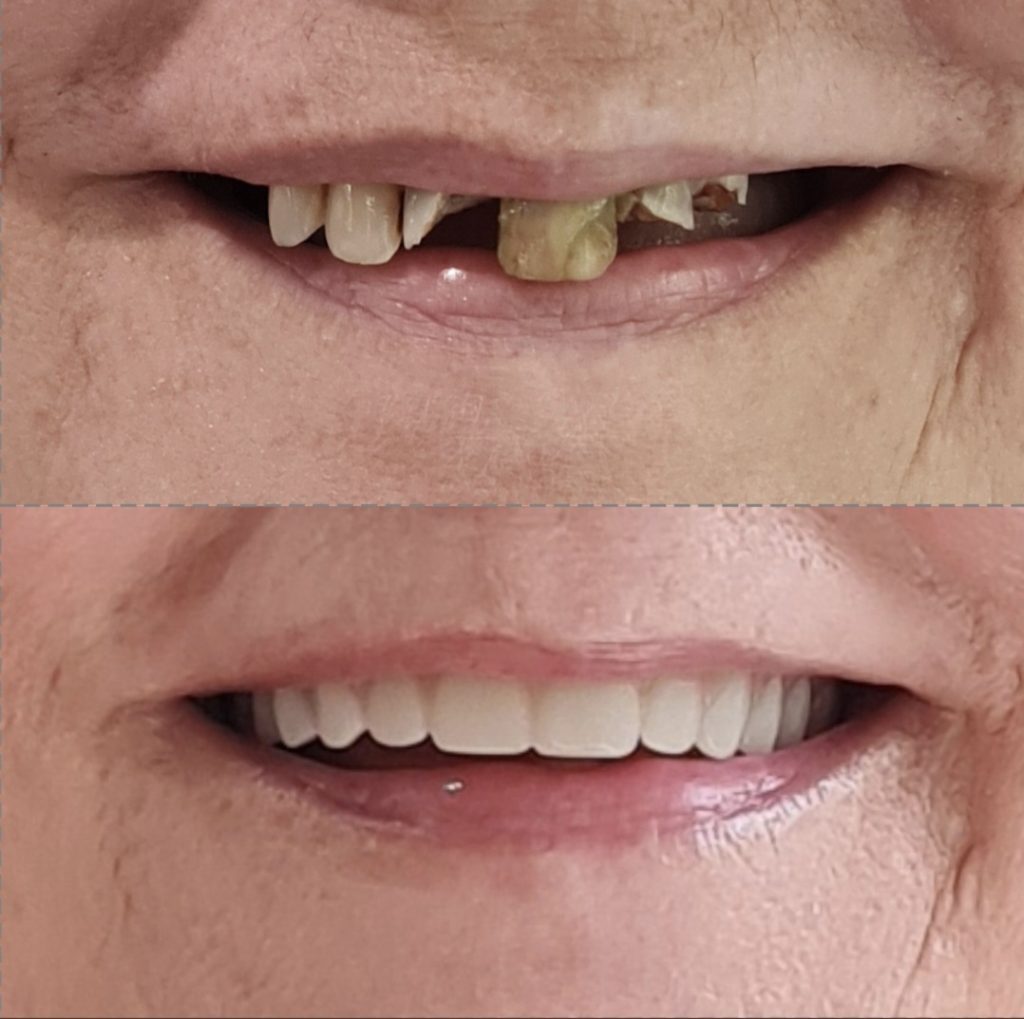 Smile Gallery - Cohen Dentistry