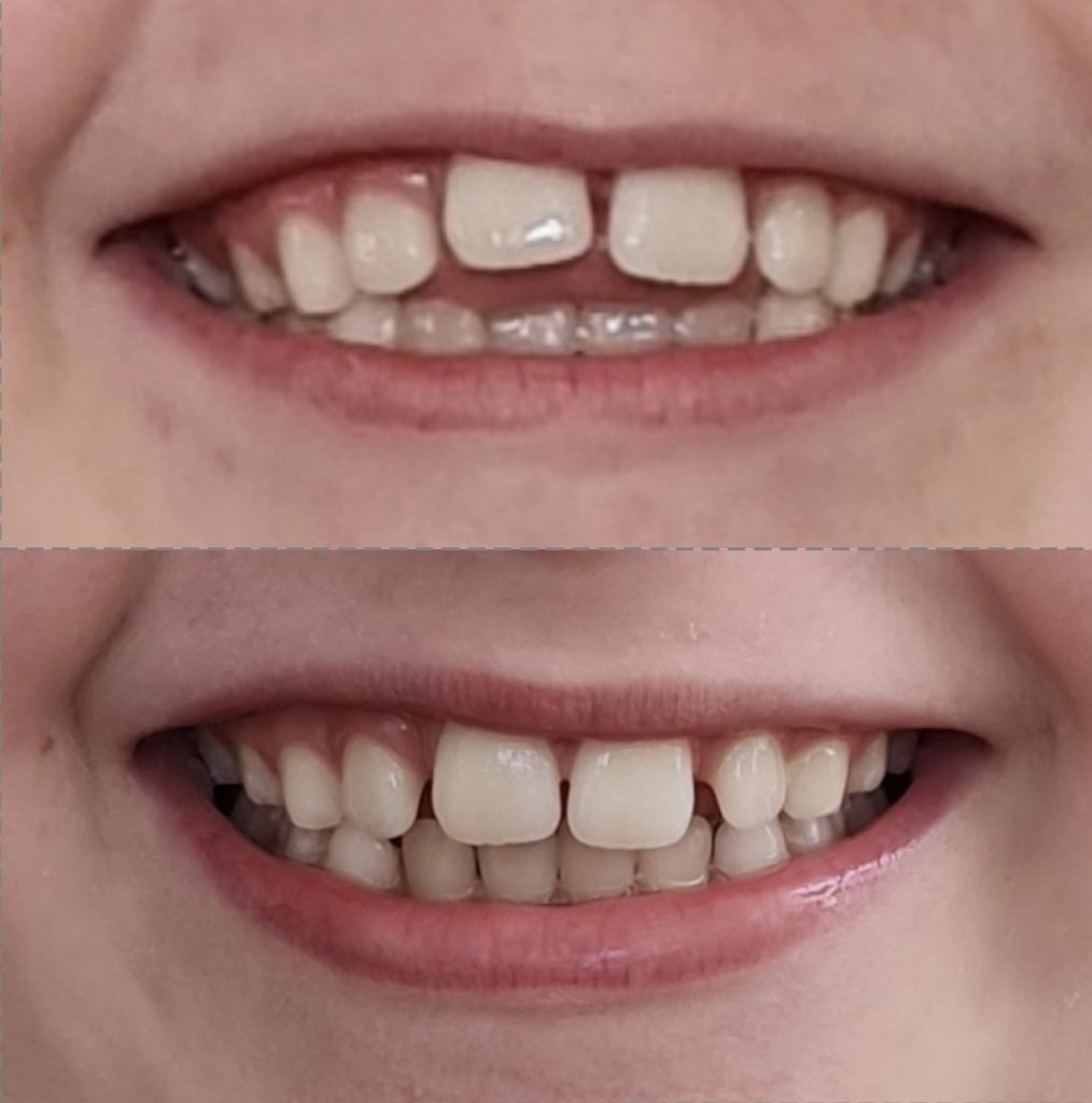 Smile Gallery - Cohen Dentistry
